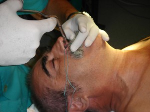 Fibroanestesia: NARIZ